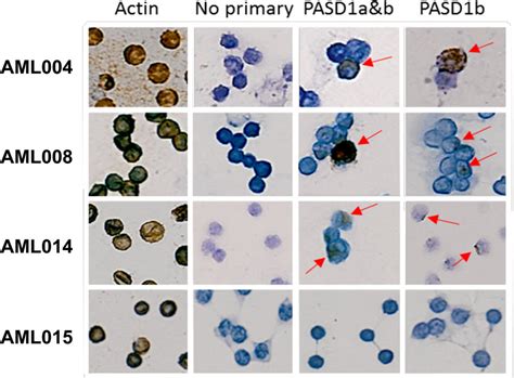 Pasd1 Expression In Aml Patient Samples Immunolabelling Was Used To Download Scientific