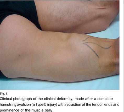 Proximal Hamstring Tendon Rupture