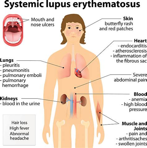 Systemic Lupus Erythematosus Illustrations Royalty Free Vector
