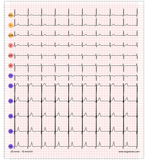 First Degree Av Block Av Block I Av Block 1 The Cardiovascular