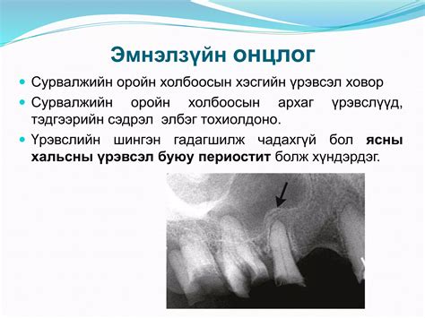 Сүүн шүдний сурвалжийн оройн холбоосын үрэвслийн шалтгаан Pptx