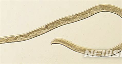 美여성 눈에서 소 기생충 14마리 나와 인간 감염 첫 사례