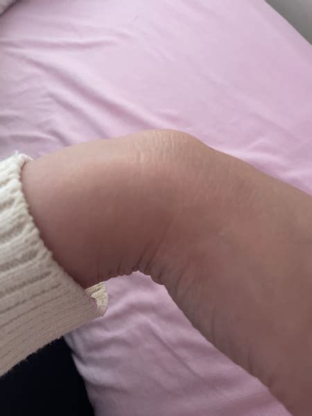 Lump On Wrist Mumsnet