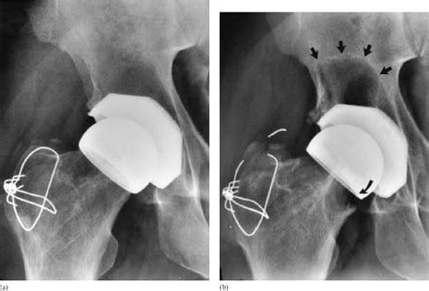 Figure 1 From The Role Of Acetabular Component Screw Holes And Or Screws In The Development Of