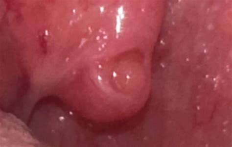 Weird Round Shape On The Bottom Of One Tonsil Rtonsilstones