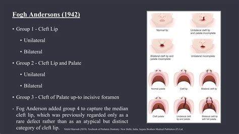 Development Of Palate And Its Anamoliespptx