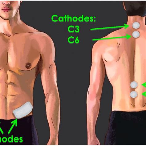 Typical Tscs Electrode Placement Transcutaneous Scs Is Commonly