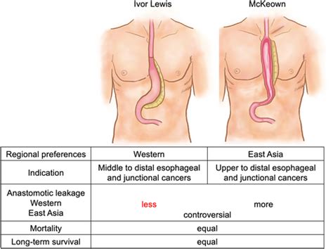 What Is The Best Reconstruction Procedure After Esophagectomy A Meta