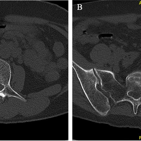 CT Scan Reveals Fractures In L And The Sacrum A Fracture In The Right Download Scientific