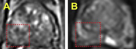 Preliminary Diagnostic Accuracy Of Multiparametric Magnetic Resonance Imaging To Detect Residual