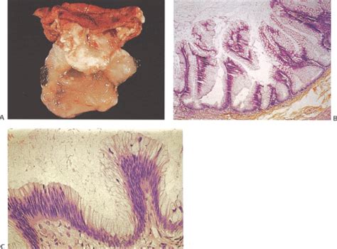 The Neoplastic Appendix Abdominal Key