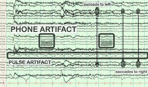 Lateral Eye Movement