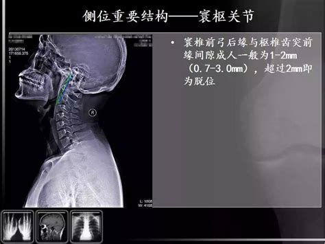 推荐 颈椎X线片怎么看 好医术早读文章 好医术 赋能医生守护生命