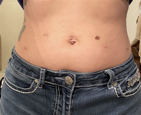 Laparoscopic Hysterectomy Scars Laparoscopy Hysterectomy Dr Manish