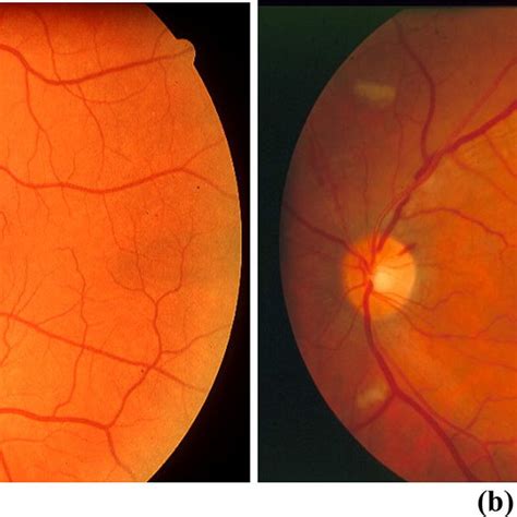 Exudate Characterization To Diagnose Diabetic Retinopathy Using Generalized Method