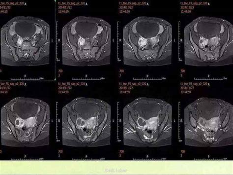 双侧卵巢囊腺瘤手术 医联