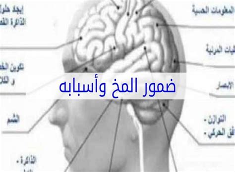 ضمور الدماغ