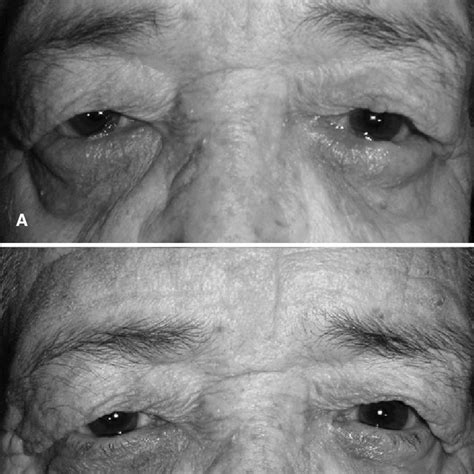 Patient With Involutional Entropion In The Both Eyes A Before The Download Scientific