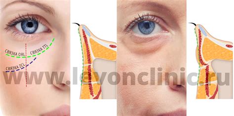 Мы расскажем об Большие мешки под глазами что делать