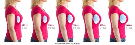 What Happens After A Breast Reduction Artofit