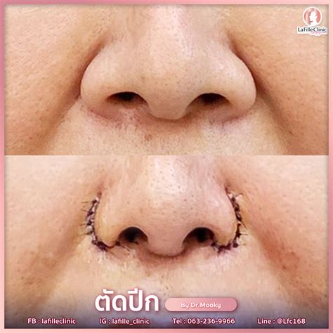 รีวิวตัดปีกจมูก คลินิกความงาม