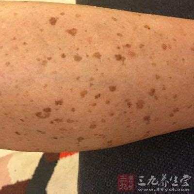 年轻人手上长斑图片 手背上图片 手上长的图片 第3页 大山谷图库