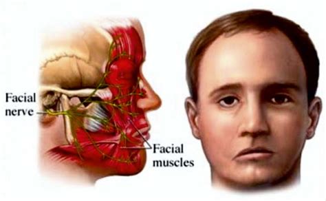 Hemifacial Spasm The Stoneygate Eye Hospital Leicester