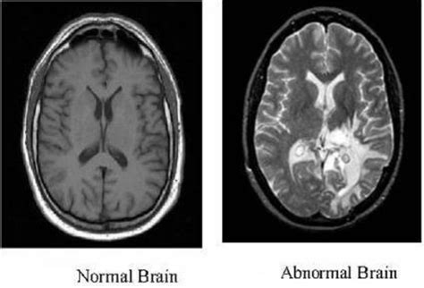 Figure From Brain Tumor Classification Using Convolutional Neural Network With Neutrosophy
