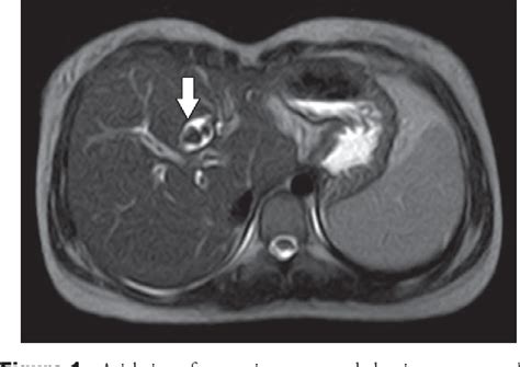 Figure 1 From Laparoscopy Assisted Transjejunal Endoscopic Retrograde