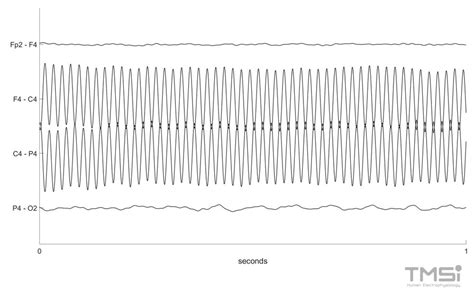 Tmsi — An Artinis Company — Common Non Physiological External Eeg Artifacts