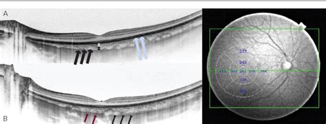 Figure 1 From Choroidal Imaging With Swept Source Optical Coherence Tomography A Review