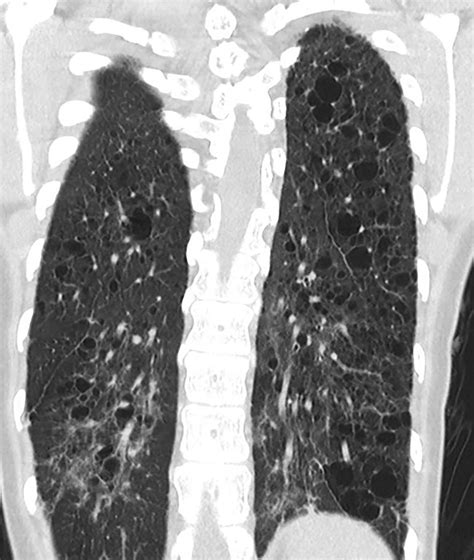 Surfactant Protein C Deficiency Associated Diffuse Lung Disease Applied Radiology