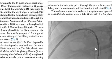 Percutaneous Transhepatic Cholangiography Demonstrates A Tight Biliary