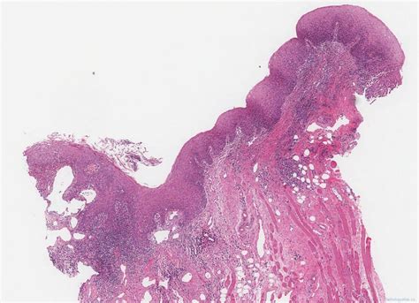Acute Mucositis Of The Oral Cavity Ottawa Atlas Of Pathology