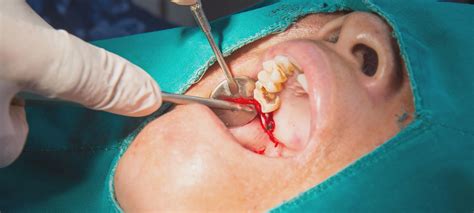 Wisdom Teeth Removal Recovery