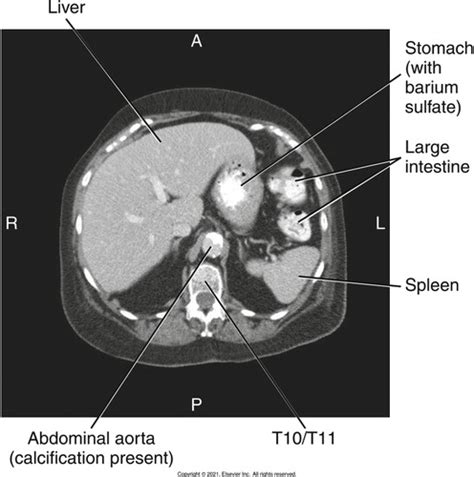 Rad 130 Lab Quiz 2 Ct Images Flashcards Quizlet