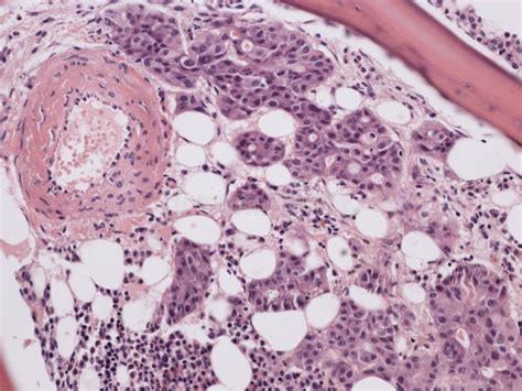 Metástasis Del Cáncer De Pulmón En La Médula ósea Foto De Archivo Imagen De Enfermedades