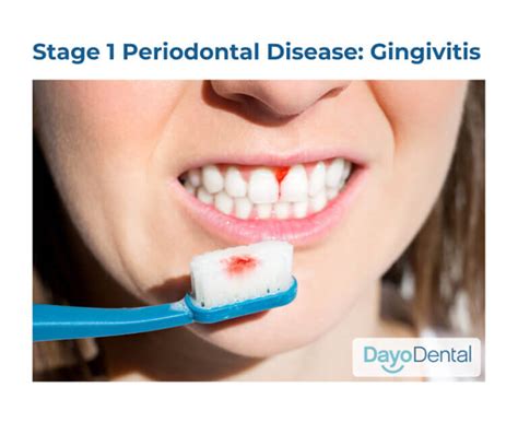 Gingivitis Vs Periodontitis Stages Of Gum Diseases Explained