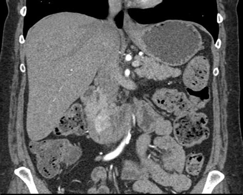 Duodenal Gist Tumor Looks Like Pancreatic Neuroendocrine Tumor Pnet Small Bowel Radiology