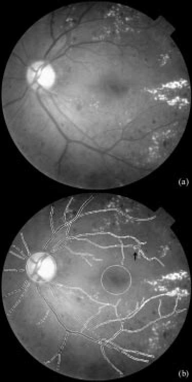 An Application Of Second Order Gaussian Filter For Retinal Vessel Download Scientific Diagram
