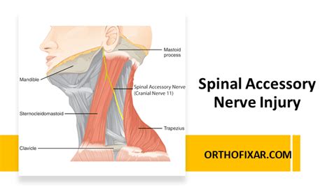 Spinal Accessory Nerve Injury