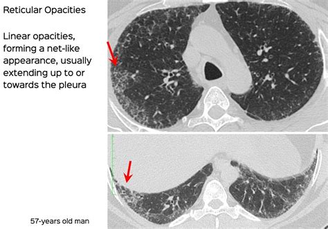Lecture Fibrosing Ilds Understanding Reticular Opacities Traction Bronchiectasis And