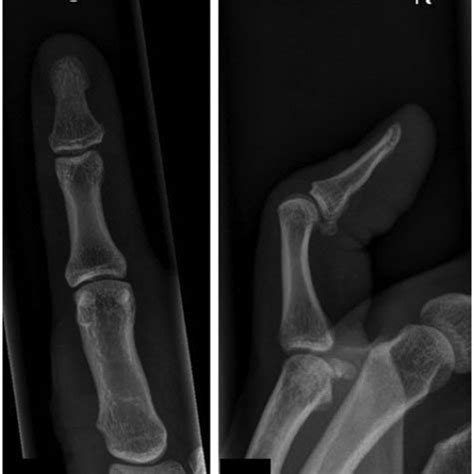 Intraoperative Photo Documentation A Total Rupture Of The Epl Close