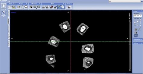 Axial View Of Cone Beam Computed Tomography Cbct With Artifact Download Scientific Diagram