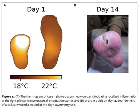 Remote Temperature Monitoring In Diabetic Foot Ulcer Detection