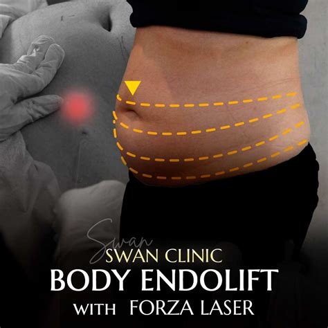 Body Endolift For Belly And Flanks With Forza Laser In Dubai A Modern