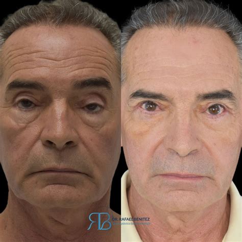 Blefaroplastia Dr Rafael Benitez