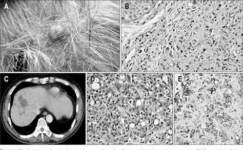 Figure 1 From Cutaneous Metastasis From Cholangiocarcinoma As The First Clinical Sign A Report