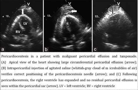 Pericardiocentesis Procedure Anatomical Structures And Approaches Open Access Pub