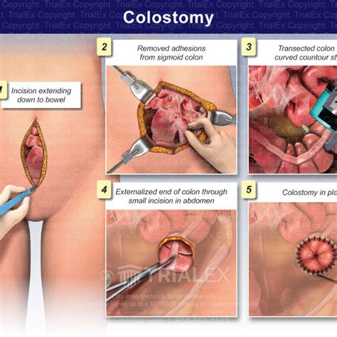 Colostomy TrialQuest Inc